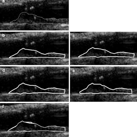 Pdf Atherosclerotic Carotid Plaque Segmentation In Ultrasound Imaging