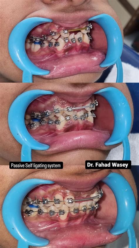 Dr Fahad Wasey On Linkedin The Passive Self Ligating System Is Designed To Reduce Friction