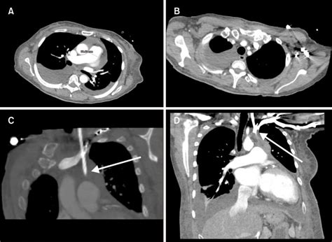 Physician Modified Fenestrated Endovascular Repair For Iatrogenic