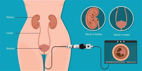 输尿管结石 Allen Sim Urology