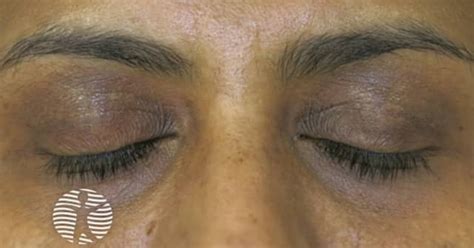 Acquired Dermal Macular Hyperpigmentation Image