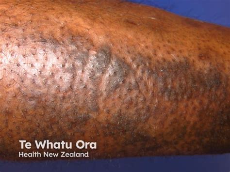 Neurodermatitis Dermnet Prescribing For Contact Eczema Dermatitis
