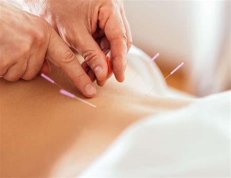 The Ultimate Guide To Dry Needling For Sciatica The Ultimate Guide To Dry Needling For Sciatica