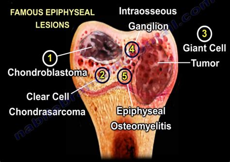 Growth Plates Physisepiphysis And Apophysis By Nabil Ebraheim Medium