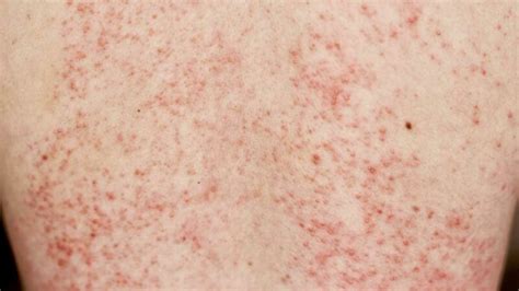 What Does A Blood Disorder Rash Look Like Torrinomedica
