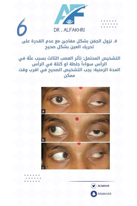 ٧ حالات طارئة في العيون لاتحتمل التأجيل ثريد مبسّط على شكل صور صحةالعيون صوتالطبيب