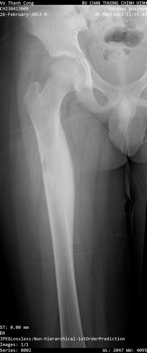 Bone Dataset 2 Instance Segmentation Dataset And Pre Trained Model By
