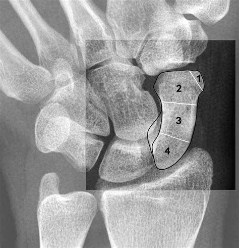 scaphoid fracture classification