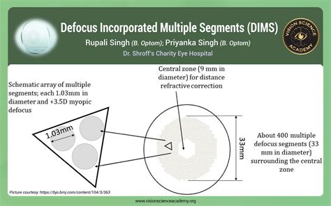 Defocus Incorporated Multiple Segments Dims Vision Science Academy