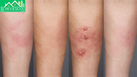 Can Mold Cause A Rash Signs Symptoms And Treatment Guide