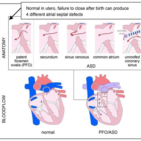Atrial Septal Defects Download Scientific Diagram