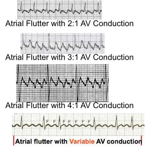 Atrial Tachycardia Vs Atrial Flutter AdelineatDiaz