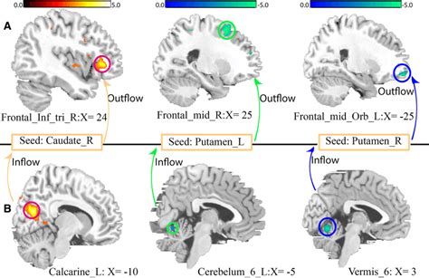 Causal Connectivity Differences Between Fle And Healthy Controls A Download Scientific Diagram