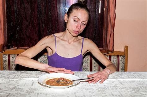Anorexia Nervosa Pictures Famous People