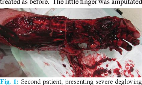 Figure 1 From Degloving Injuries Of Upper Extremity A Strategy With