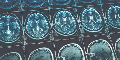 Frequent Choking During Sex Linked To Abnormal Neural Activation