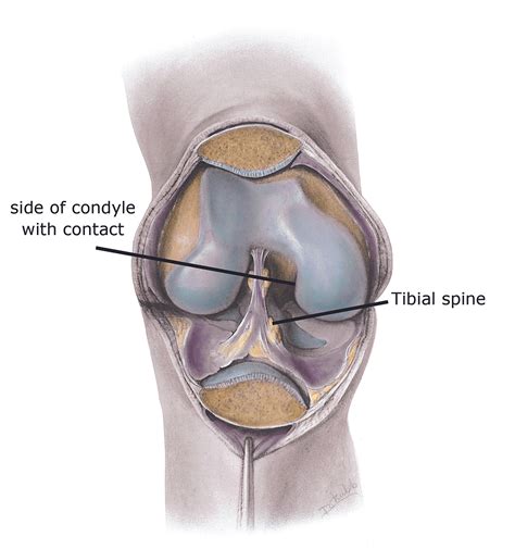 Osteochondritis Dissecans