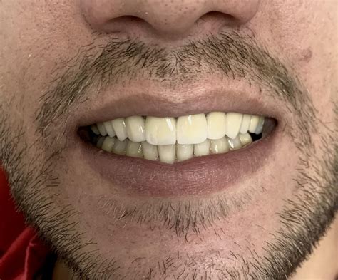 კიდევ ერთი გახარებული პაციენტი…💯 ექიმი შოთა ზაქარაშვილი ტექნიკოსი გოჩა ექიმი სტომატოლოგი