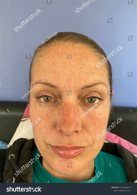 Face Woman Hyperpigmentation Rare Addisons Disease库存照片1961480617 Shutterstock