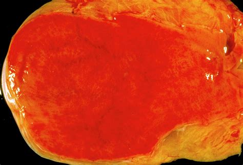 Gallbladder Inflammation By Science Photo Library