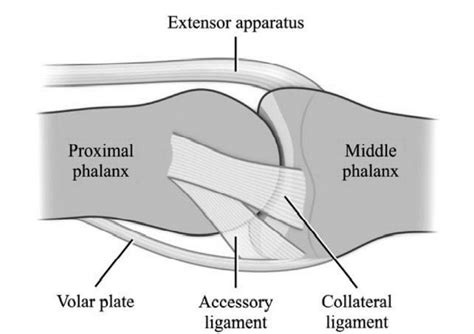 Sideline Management Of Pip Dislocation Sports Medicine Review Sideline Management Of Pip Dislocation Sports Medicine Review