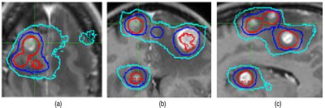 Comparison Of Monte Carlo Dose Contours Based On The True Ct And Sct Download Scientific