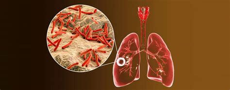 Best Tuberculosis Specialist In Vashi Dr Jayalakshmi Tk