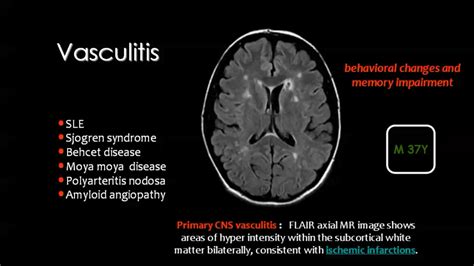 White Matter Disease Mri Mri Lesions Diffuse Axial Diseases Club Center