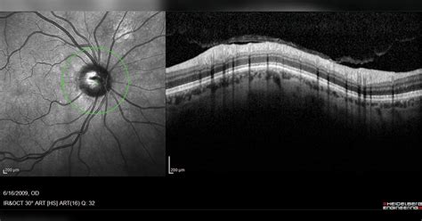 Early Diagnosis Treatment Of Glaucoma Using Advanced Technology Is An Ethical Obligation