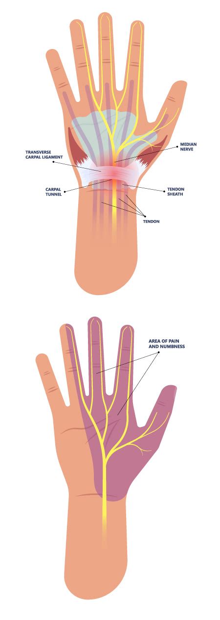 Understanding Carpal Tunnel Syndrome