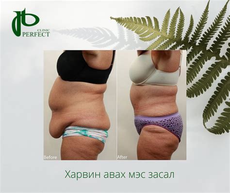 🌱ХАРВИН АВАХ МЭС ЗАСЛЫН Перфект эмнэлэг Perfect Clinic