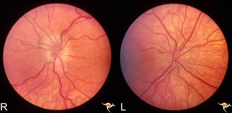 Pseudopapilledema