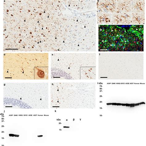 Astrocytic αsyn Inclusions In Dlb Patients Specifically Detected By An