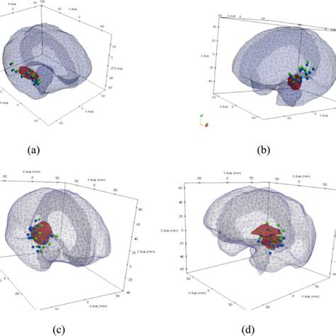 Landmarks For Brain Shift Registration After Skull Opening And Before