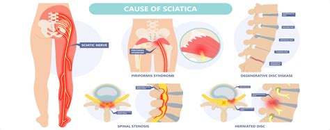 Qualified Hurstville Chiropractor For Sciatica Treatment