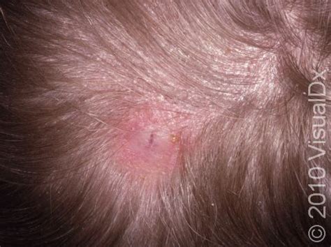 Ringworm On Scalp Behind Ear