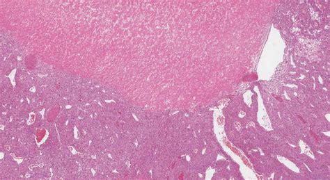 Geographic Necrosis Archives Ottawa Atlas Of Pathology