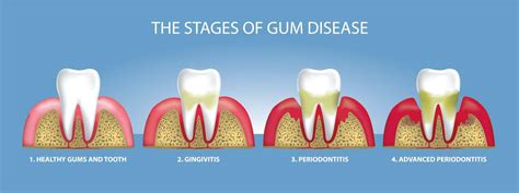 Gum Disease 牙龈疾病