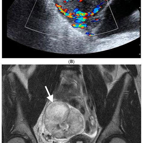 A Shows A Well Circumscribed Left Ovarian Mass Measuring 10 X 75 × Download Scientific