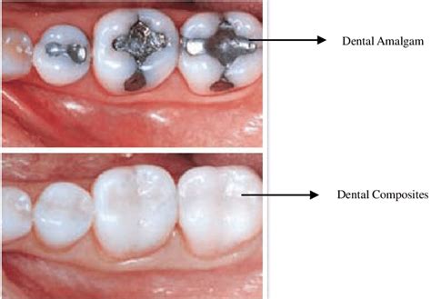 Composite Dental