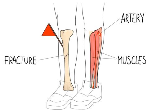 Compartment Syndrome Gemini Osteopathy