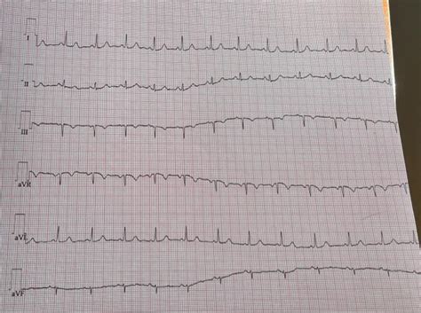 Solved Determine The Axis On The Ecg Printout Down To The