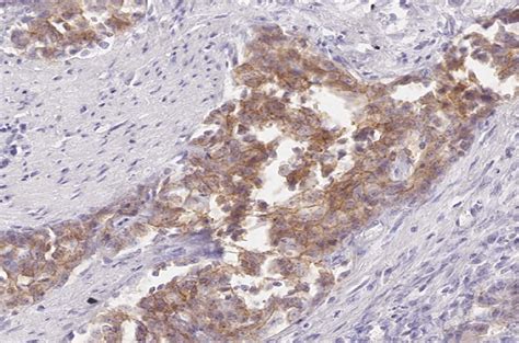 Immunohistochemistry Stain Her2neu Score 2 Equivocal Negative