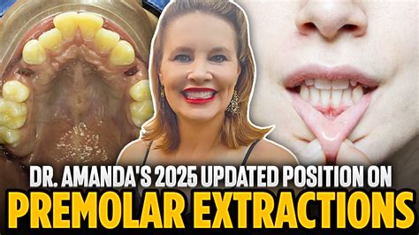 Dr Amandas Position On Premolar Extractions 2025 For Braces And