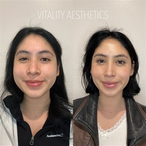 What To Expect From Jaw Botox Vitality Aesthetics