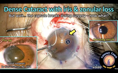 1686 Dense Iris Zonular Loss Gore Tex Artificial Cataract Coach™