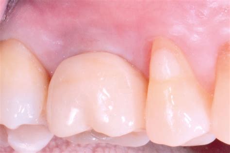 Posterior Socket Preservation Using Maxgraft® And Permamem® Dr C