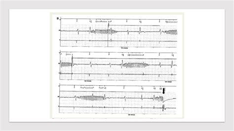 Pacemaker Overview Device And Electrodes Explained The Anesthesia Guide