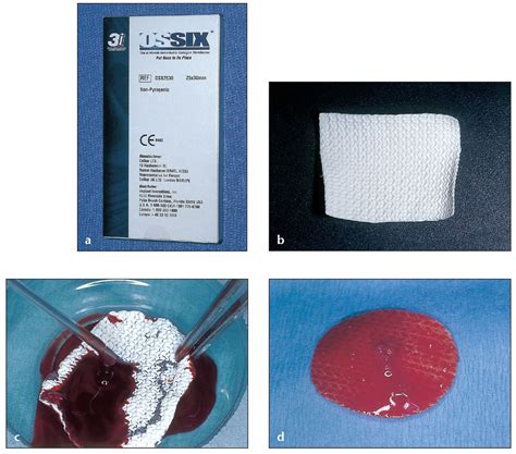 3 Barrier Membranes For Guided Bone Regeneration Pocket Dentistry