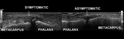 Ulnar Collateral Ligament Thumb Ultrasound